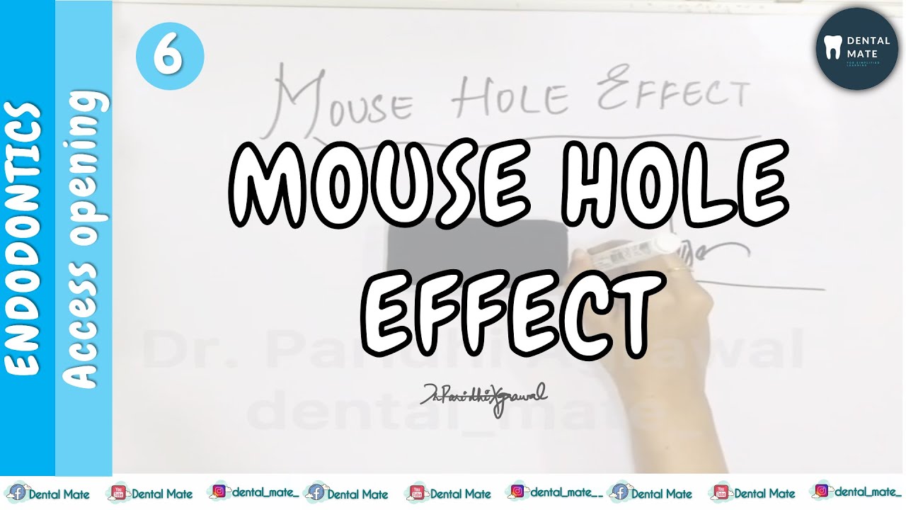 Mouse hole effect | RCT | Access Opening | Dr Paridhi Agrawal - YouTube
