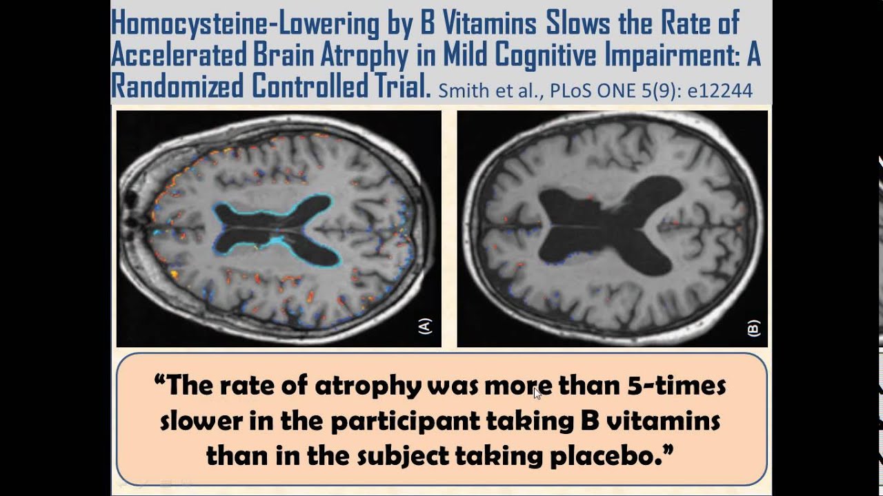 B12 and Hcy in prevention of brain atrophy - YouTube