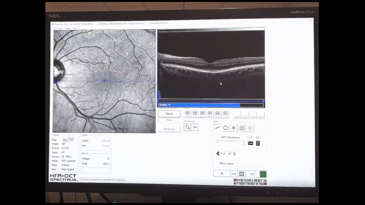 Recorded Webinar: OCT LIVE Virtual Workshop - Retina - YouTube