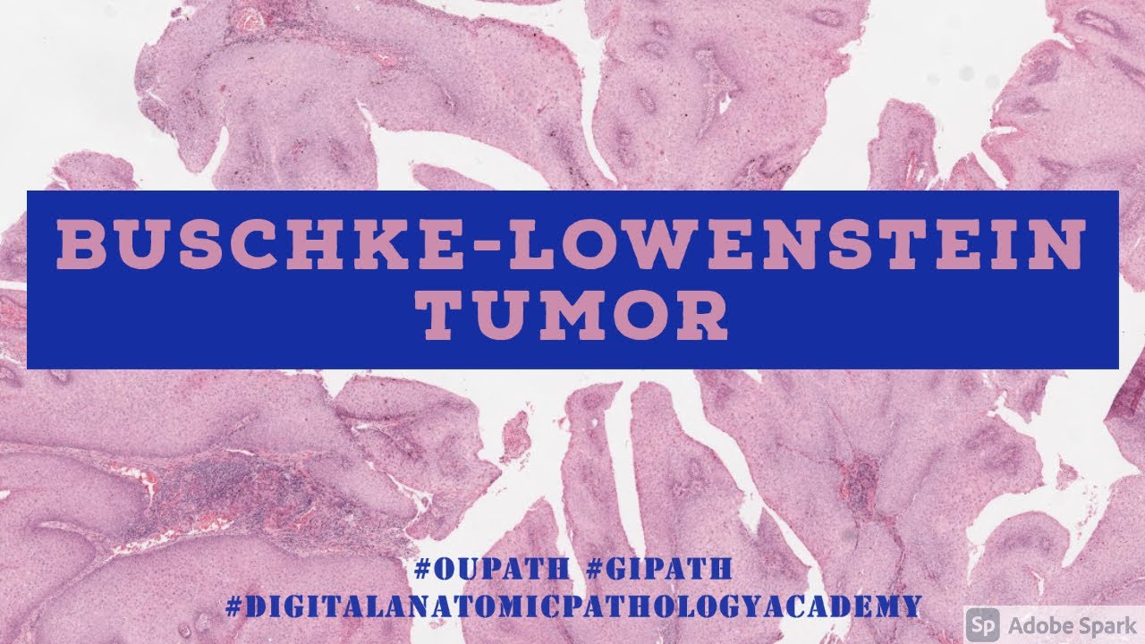 Buschke Lowenstein Tumor - YouTube