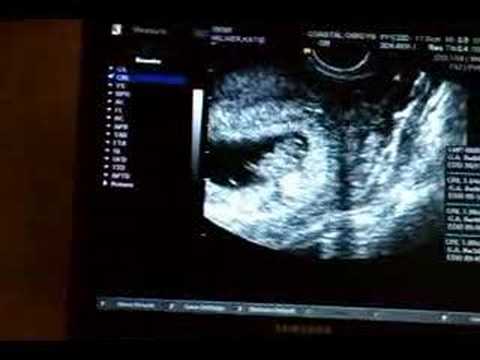 Baby ultrasound at 8 weeks - YouTube