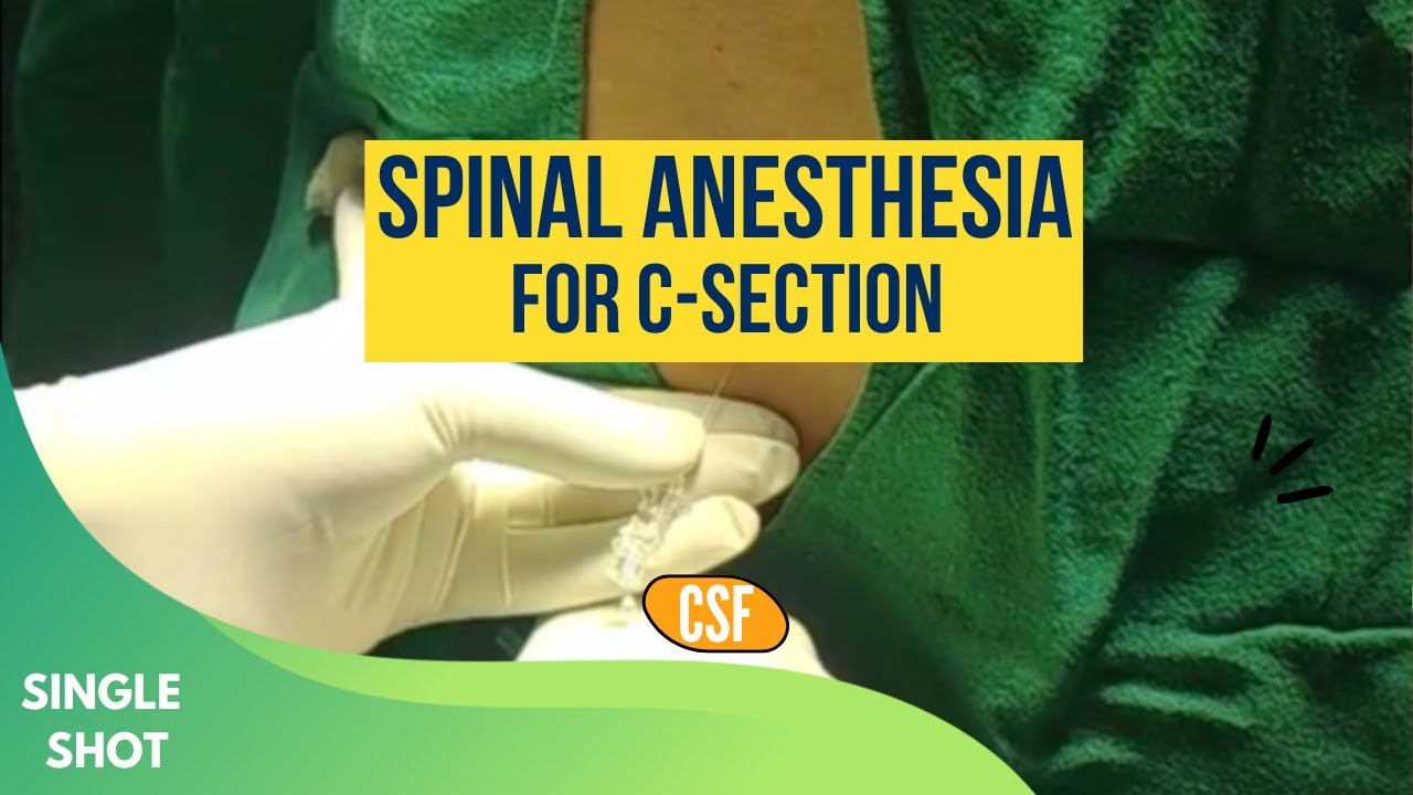 Spinal Anesthesia for C-Section | Single Shot Technique Explained - YouTube