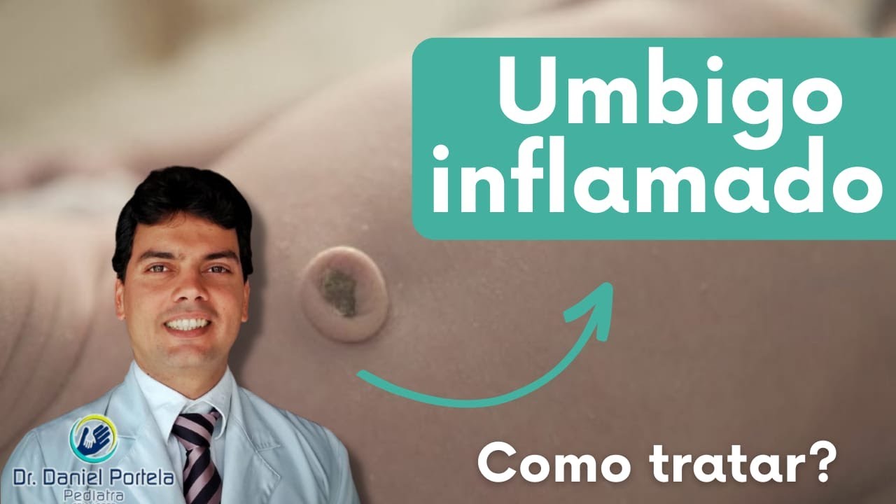 Umbigo do bebê inflamado ou granuloma umbilical: como tratar? - YouTube