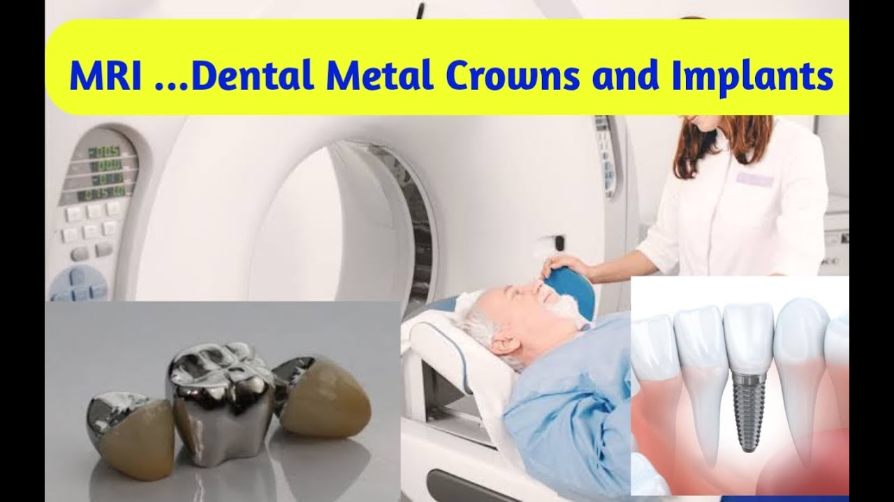 MRI ...DENTAL METAL CROWN AND IMPLANTS - YouTube