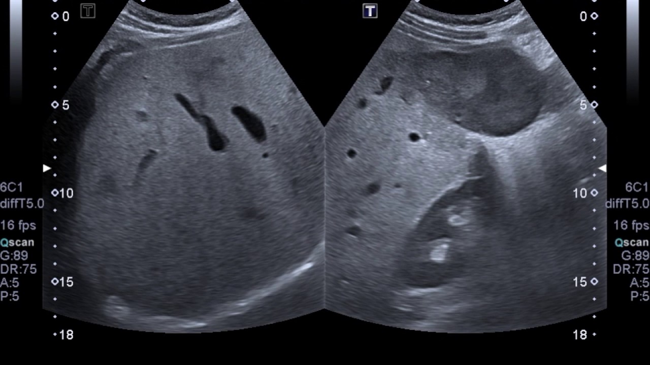 Multiple Liver Neoplasms - Focal nodular hyperplasia - YouTube