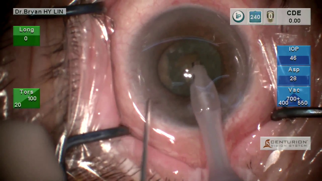 Complicated cataract surgery: Small Pupil cataract surgery - YouTube