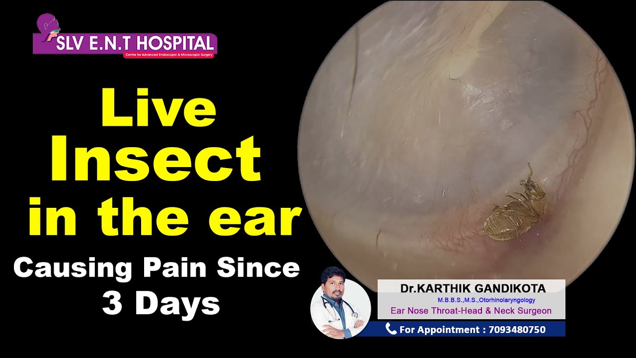 Live Insect inside the ear Causing pain since 3days - YouTube