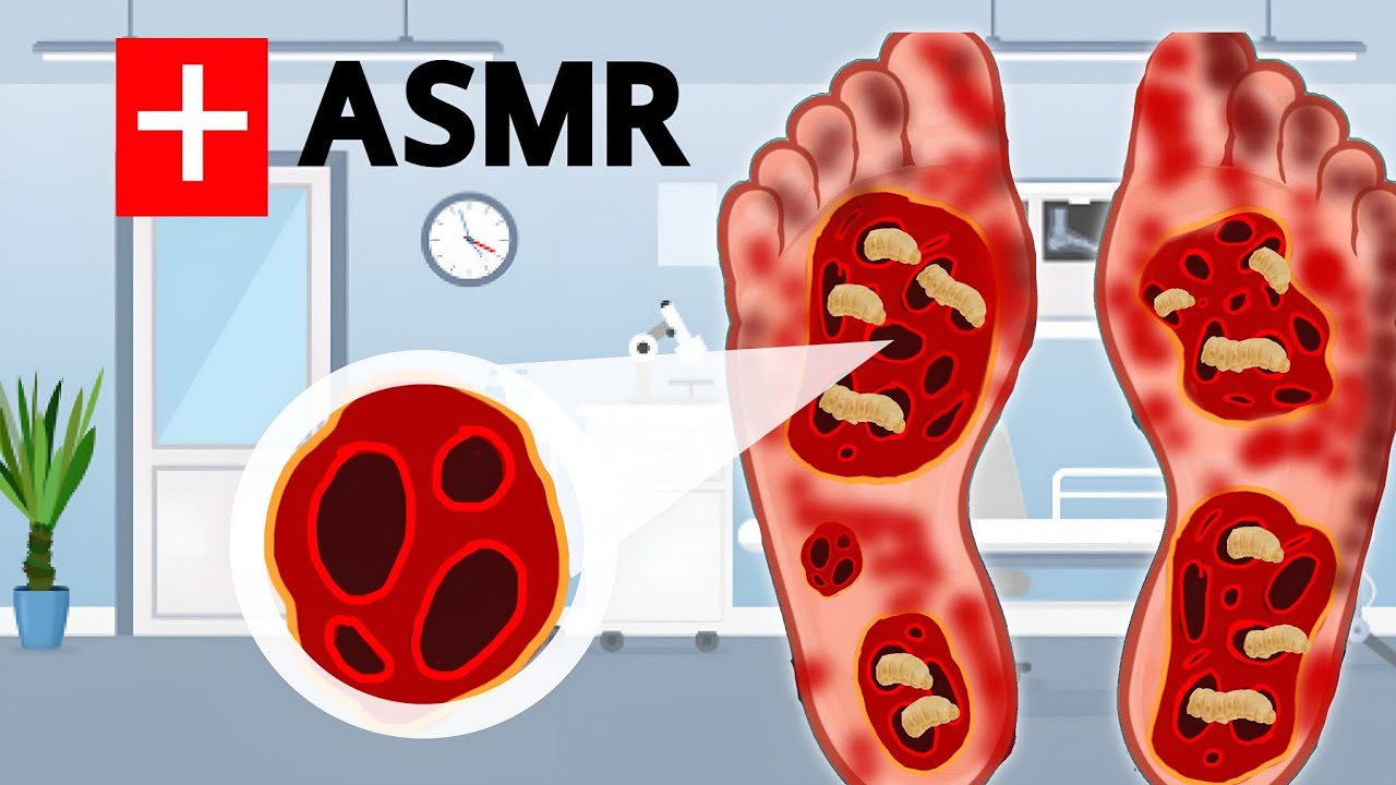 ASMR Removal Ticks & Maggot Infected Leg | ASMR Animation Removal Ticks ...