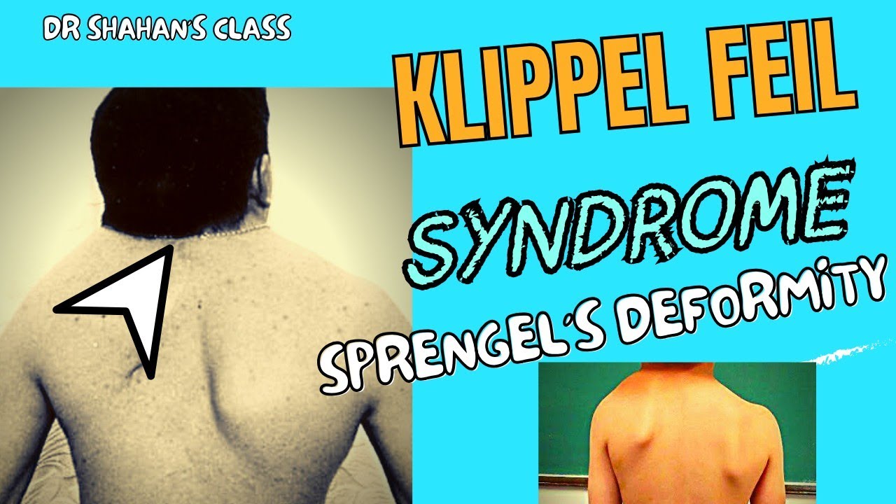 Klippel Feil Syndrome | Sprengel's Deformity - YouTube
