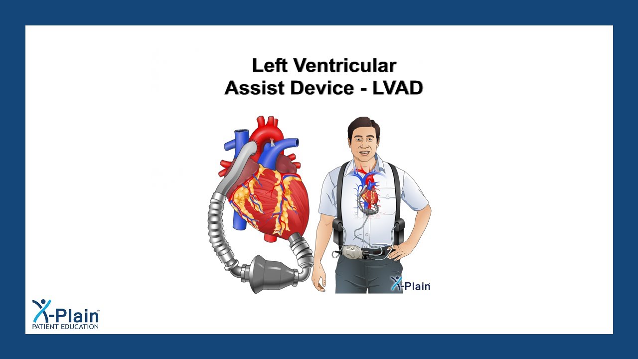 Left Ventricular Assist Device - LVAD - YouTube