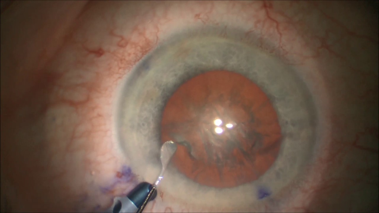 The Art of Helping a Resident Insert a Phaco Handpiece Through a 2.8 mm ...