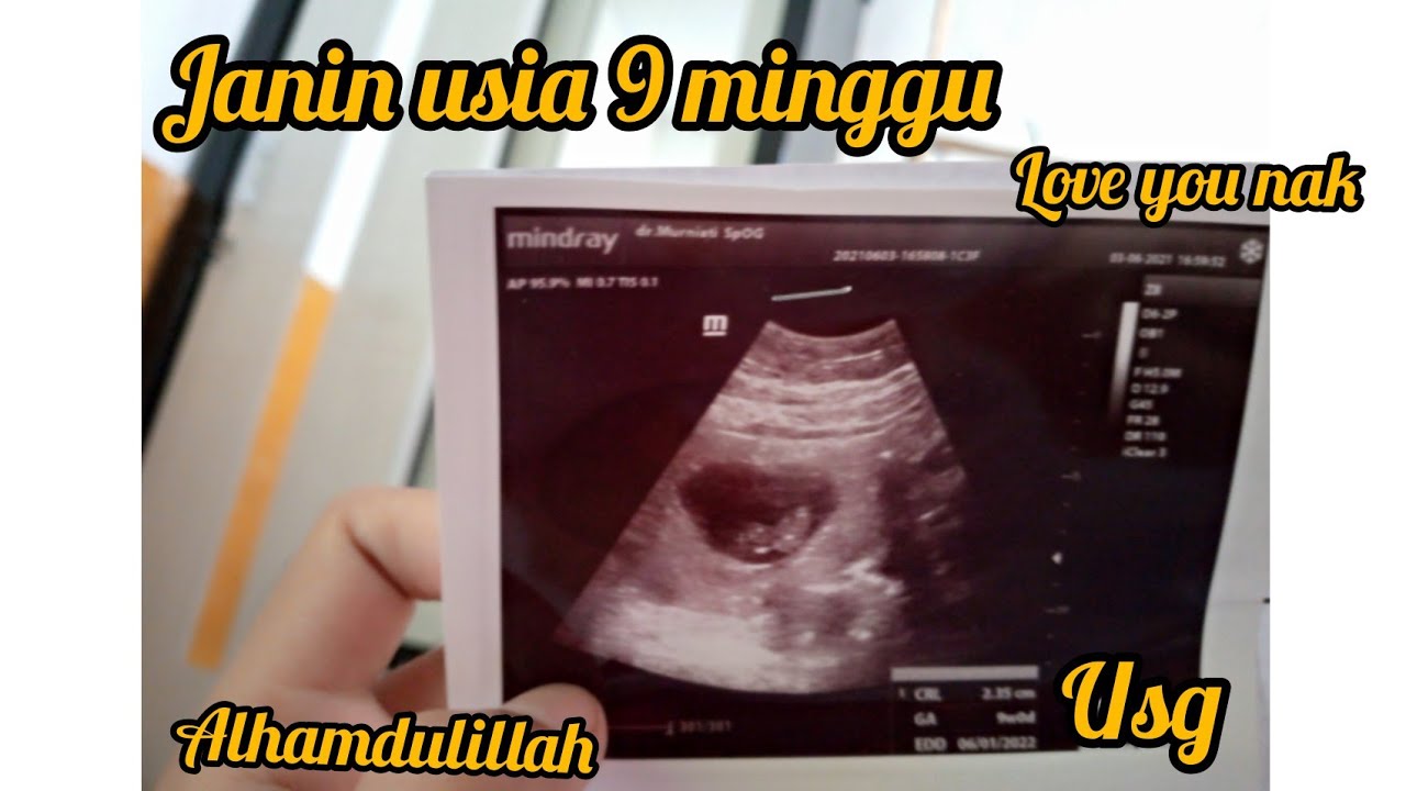 Janin 9 Minggu || USG ke-2 (3 Juni 2021) || Trimester 1 ...