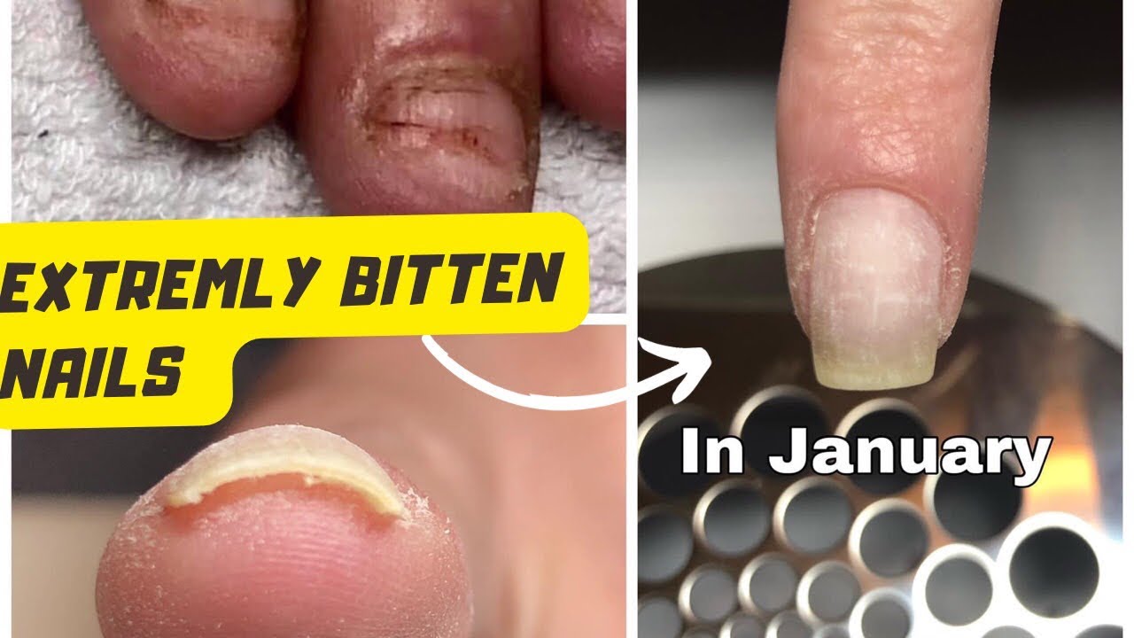Extremly bitten nails story | she was biting her nails for 50 years ...