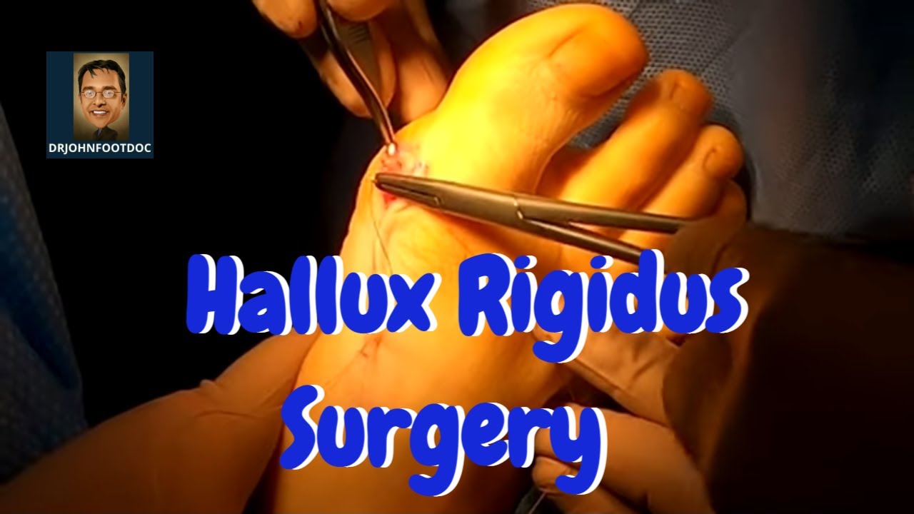 Hallux Rigidus Surgery Without Fusion or Joint Replacement - YouTube