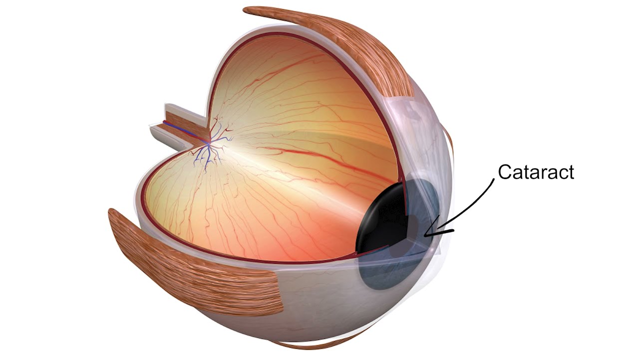 Cataract: Causes, symptoms, diagnosis & treatment. Essentials in 3 ...