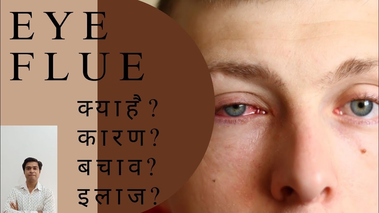 Eye Flue || How To Protect Your Eyes From Eye Flue || Shiva Health Gyan ...