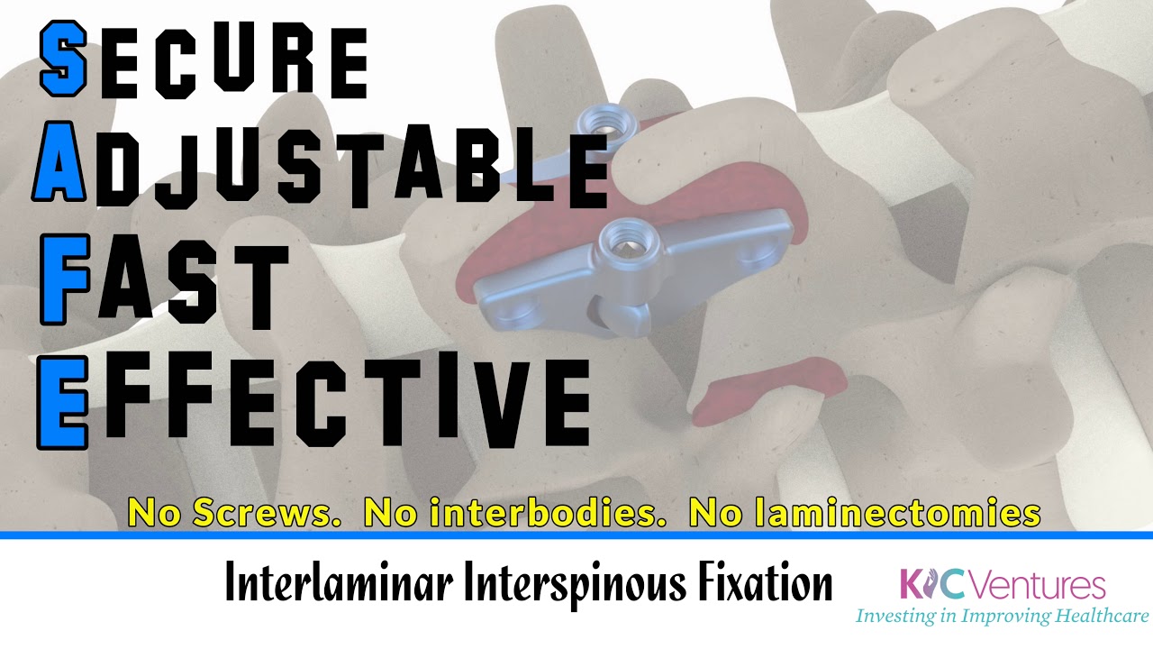 Inspan Interspinous Fixation as a New Paradigm for Lumbar Fusion - YouTube