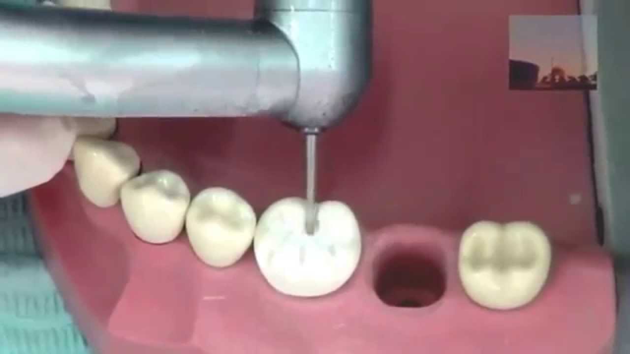 Full Metal Crown Preparation PFM Crown Preparation + Steps Under