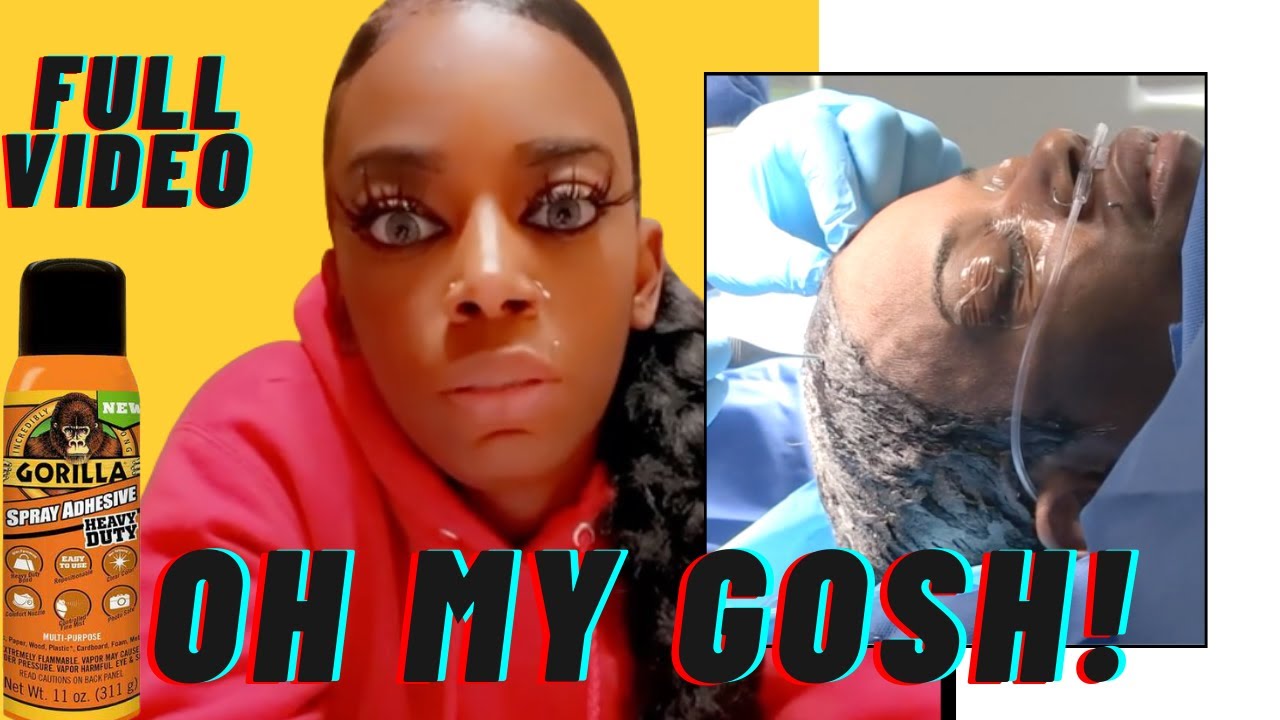 Gorilla glue girl surgery *Full video* #gorillagluegirl #tessicabrown # ...