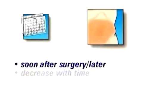 PreOp® Patient Education Spleen Removal Laparoscopic Splenectomy ...