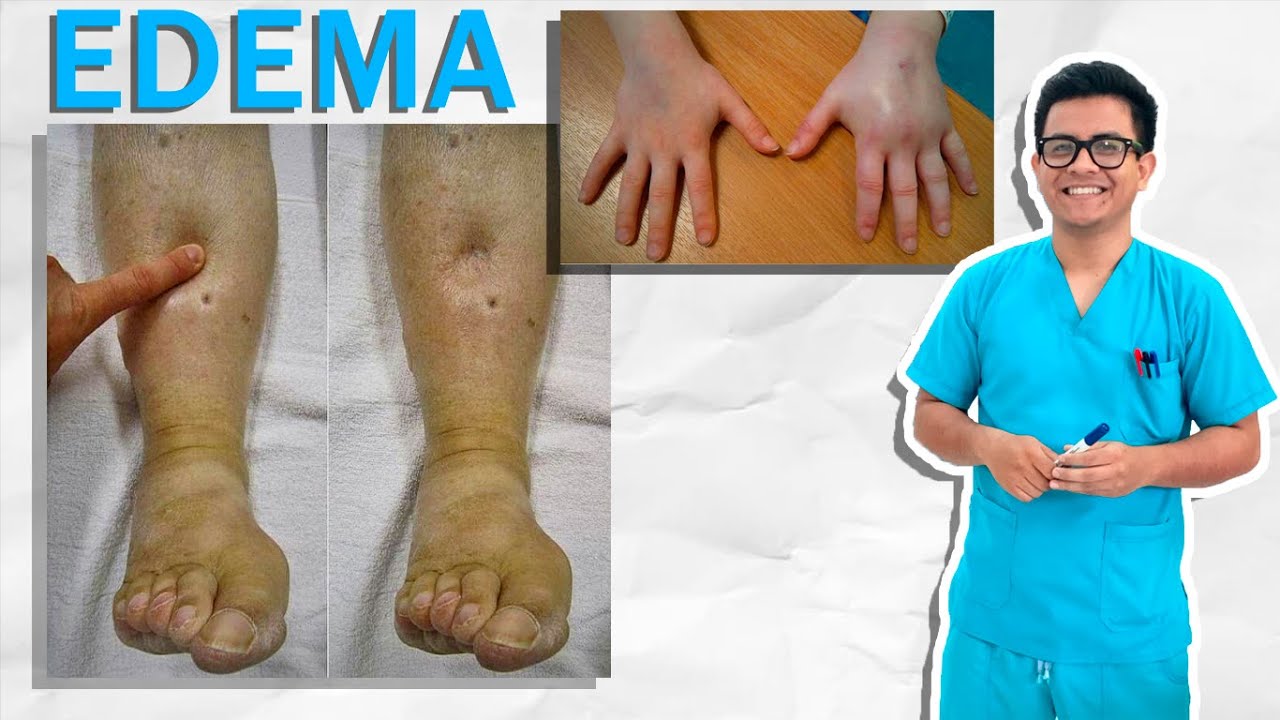 ¿Qué es el Edema? – Fácil - YouTube