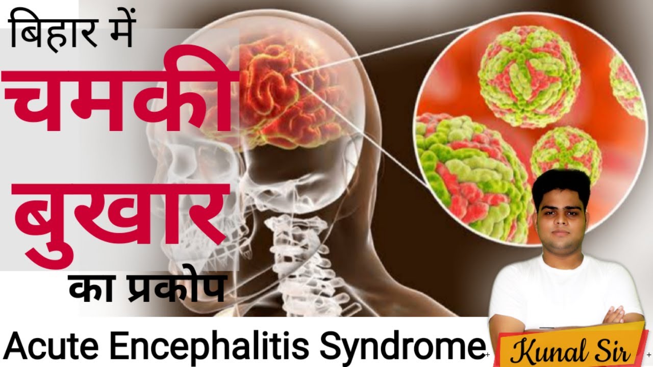 Acute Encephalitis Syndrome | Japani Syndrome | Chamki Fever Bihar by ...