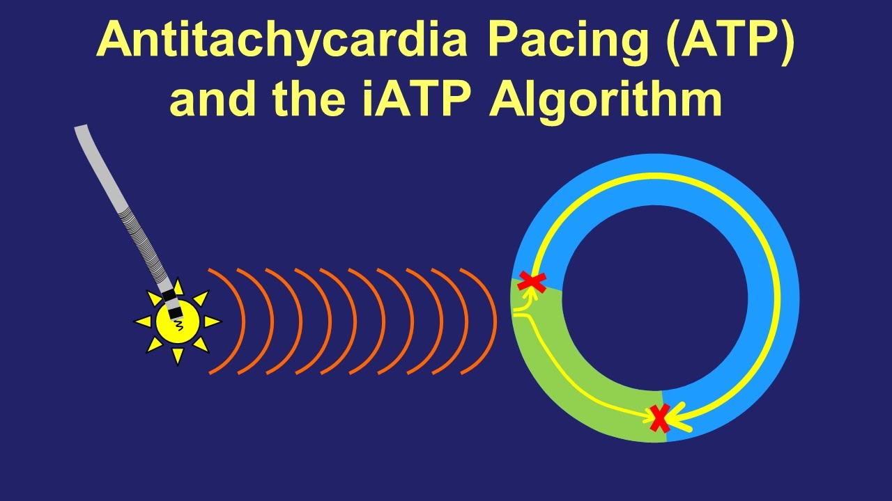 Antitachycardia Pacing (ATP) - How it Works, How to Improve - YouTube