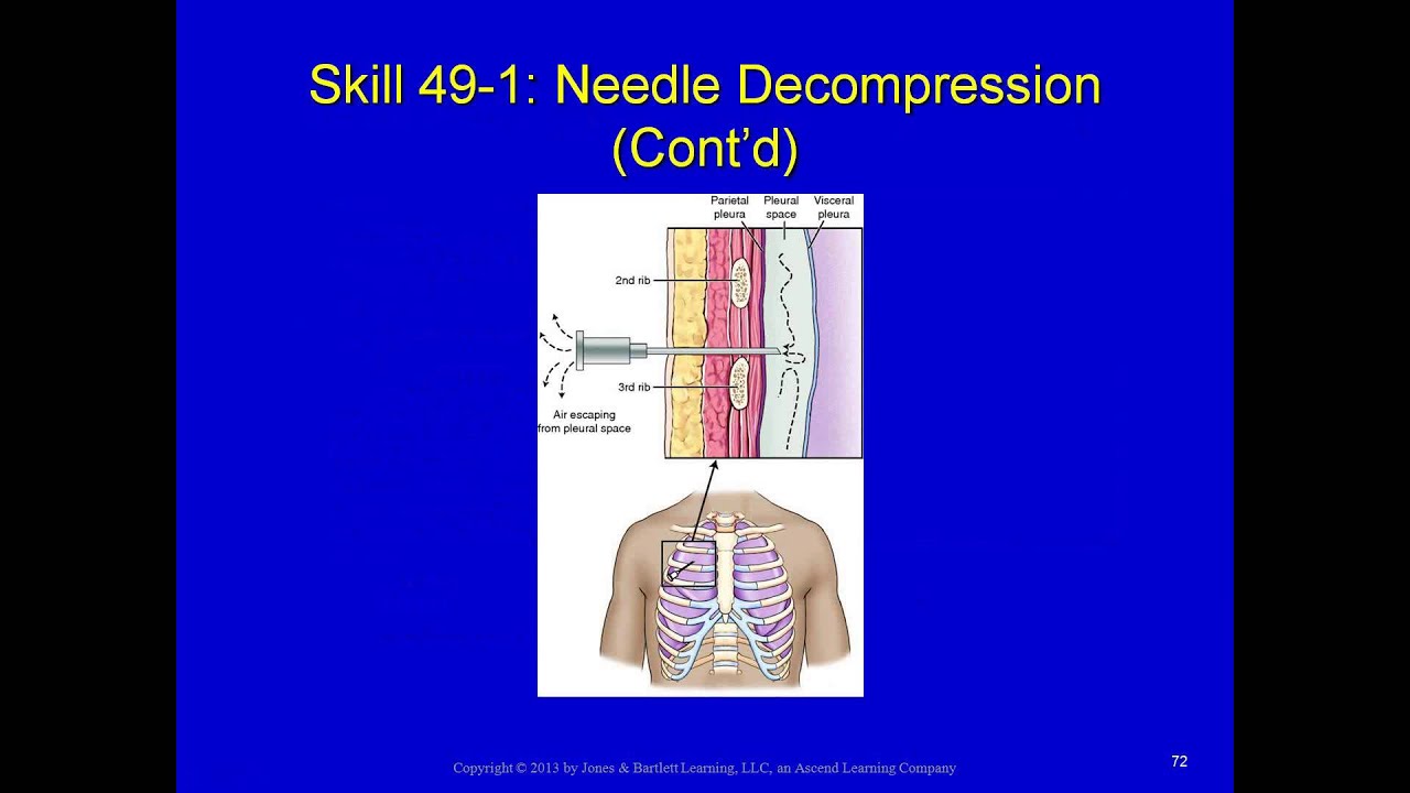 Thoracic (chest) trauma for the EMS provider - YouTube