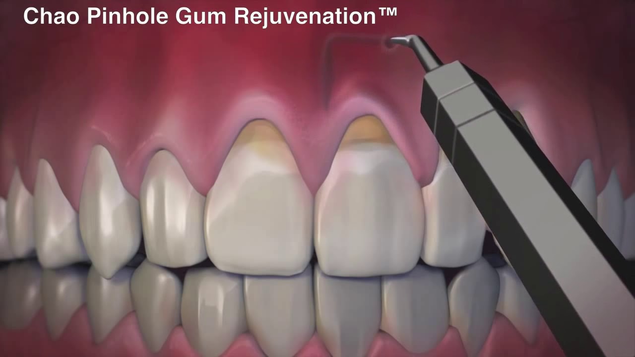 Chao Pinhole Gum Rejuvenation Chao Pinhole Surgical Technique - YouTube