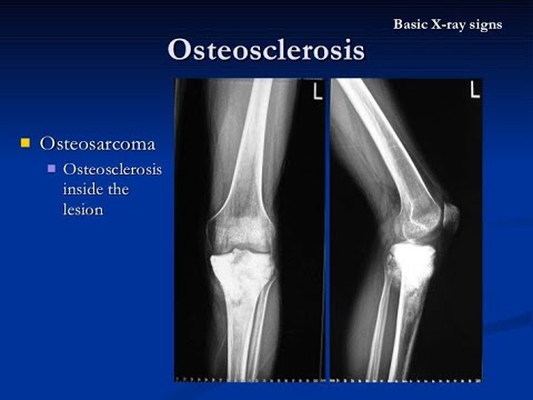 Osteosclerosis ; Introduction, Definition, Causes, Symptoms, Diagnosis ...