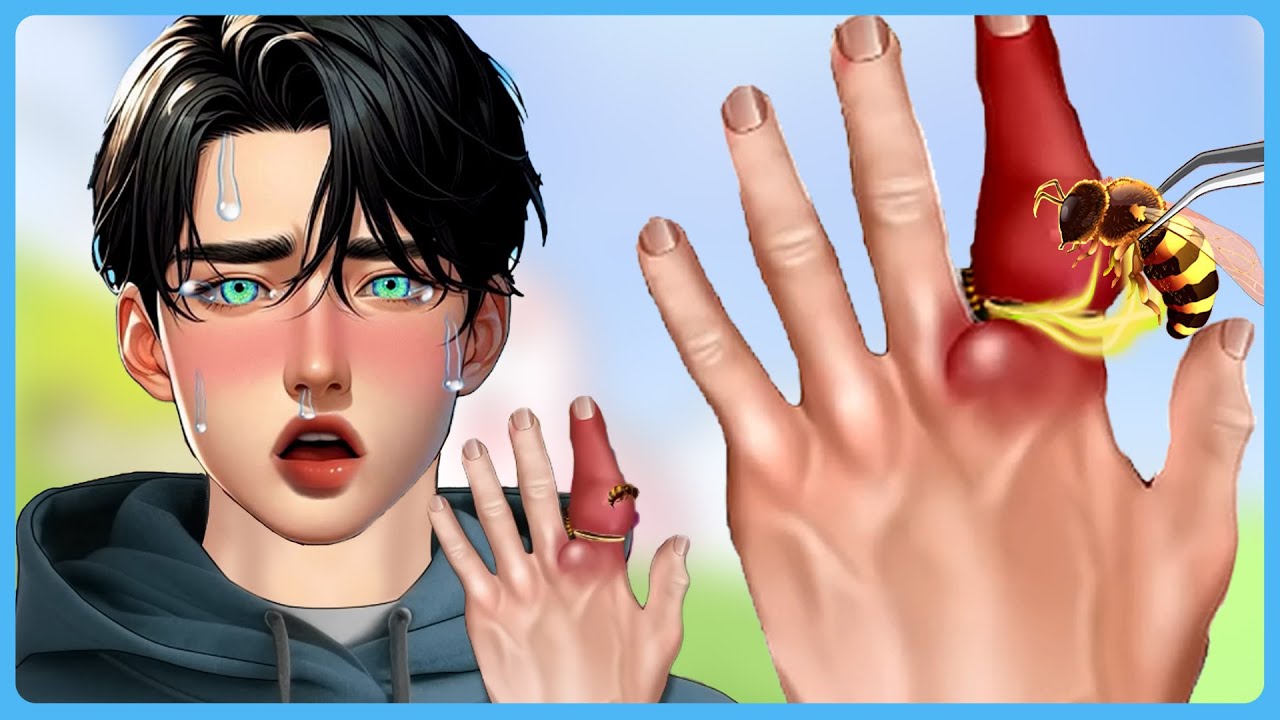 ASMR Treatment for Wasp sting Swollen Hand animation - YouTube