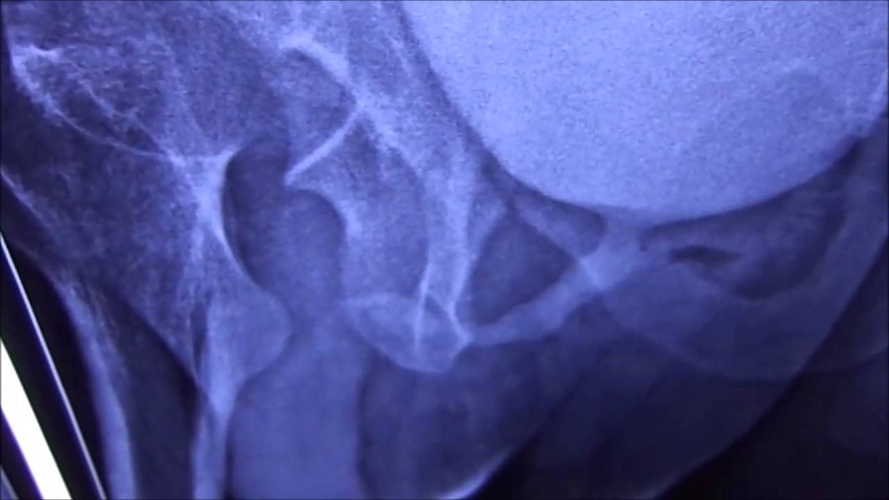 Micturating Cystourethrography (MCU) or Voiding Cystourethrogram - YouTube