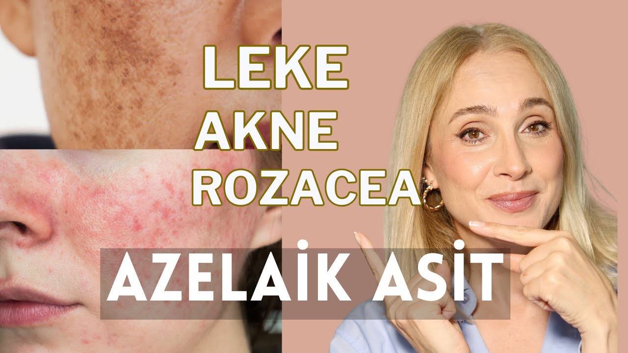 Azelaik Asit Neden Önemli : Rozacea, Leke, Akne - YouTube