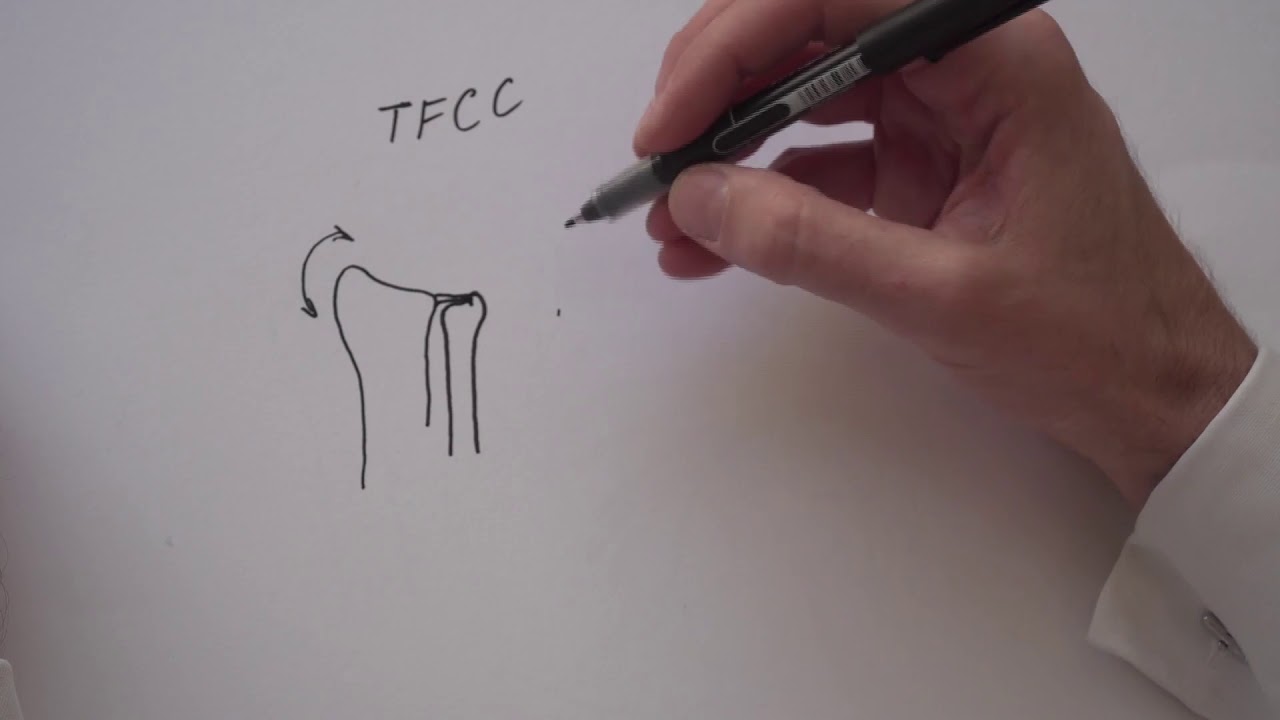 TFCC Lésion du TFCC (triangular fibro cartilage complex) - YouTube