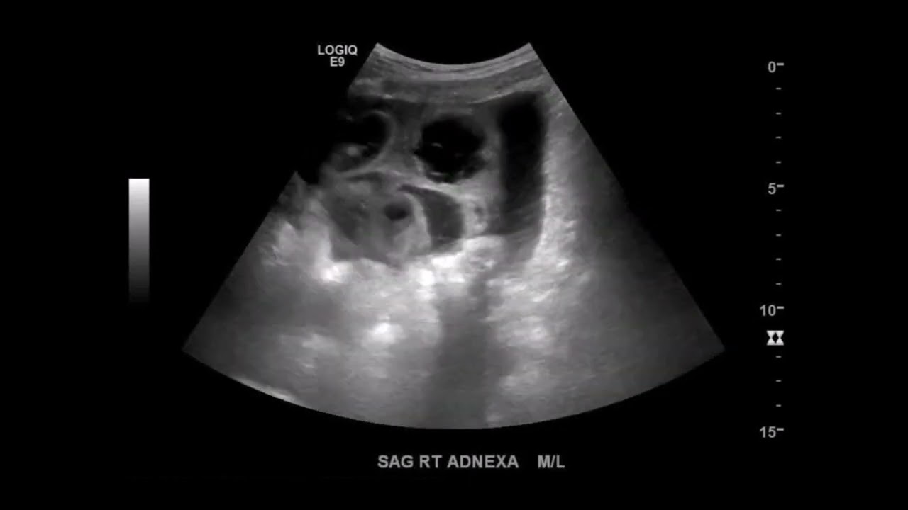 Pelvic Ultrasound: Ovarian Hyperstimulation Syndrome - YouTube
