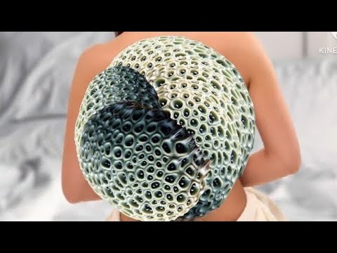 ASMR BACK SAID REMOVE MAGGOT ANIMATION TREATMENT💉@SmallASMR9 - YouTube