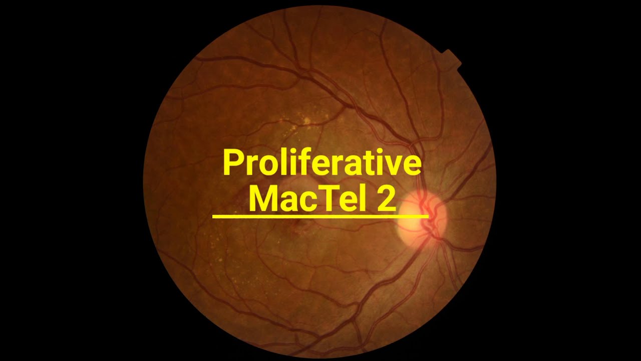 Multimodal imaging in PROLIFERATIVE MACTEL TYPE 2 - YouTube