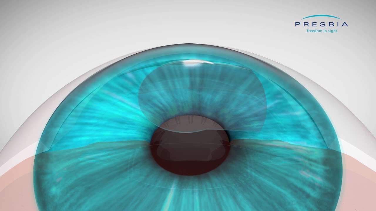 Alterssichtigkeit beheben mit der Presbia Flexivue Microlens™ – der ...
