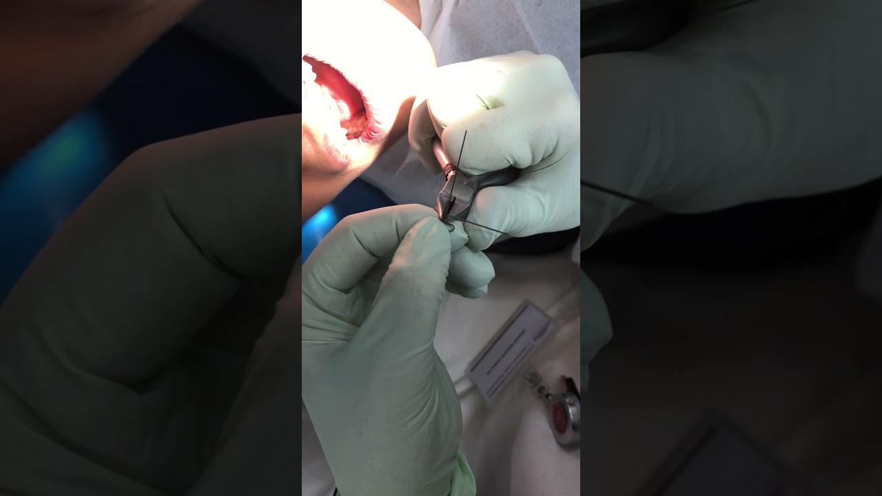 T loop bending for canine retraction - YouTube