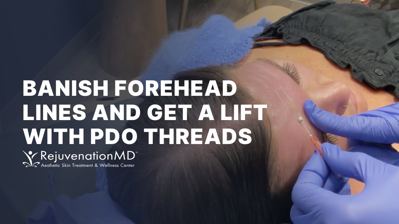 Experience the Magic of PDO Threads for Forehead Lines - YouTube