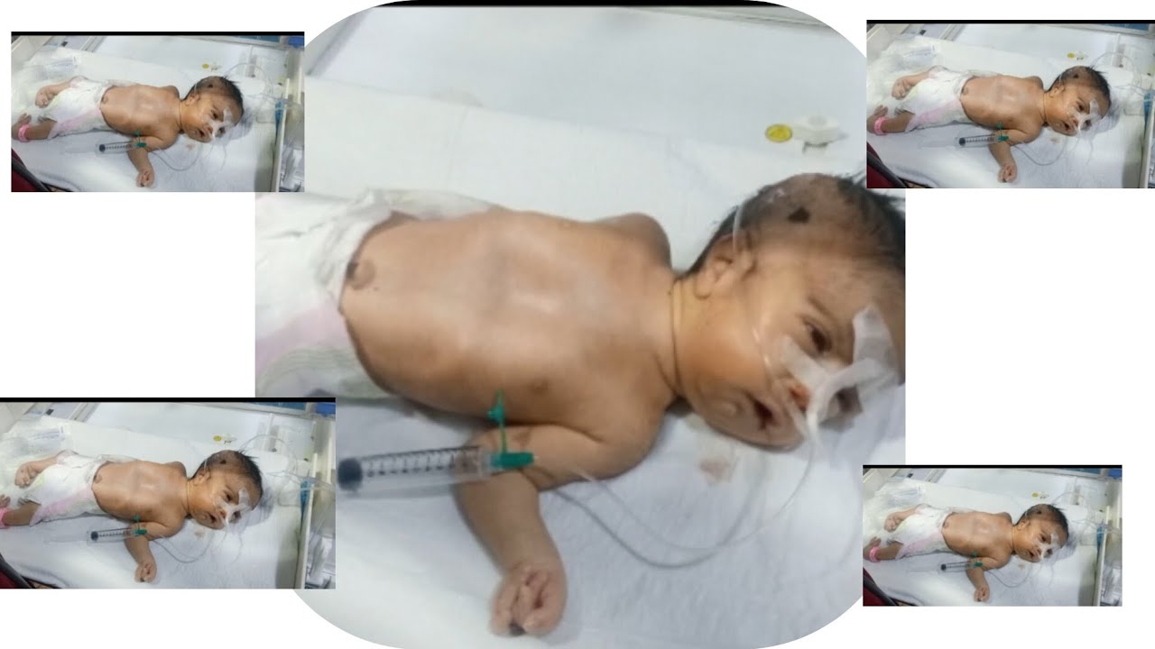 Newborn baby are hand problem in hand the baby in foot condition is ...
