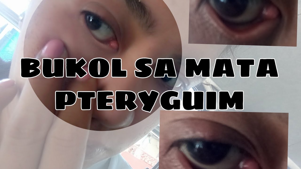 PUGITA SA MATA/ PTERYGIUM CAUSE AND CURE - YouTube