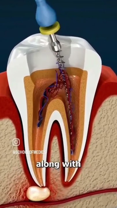 Dental Veneers Steps Andshorts Root Canal Treatment And Tooth Abscess Youtube