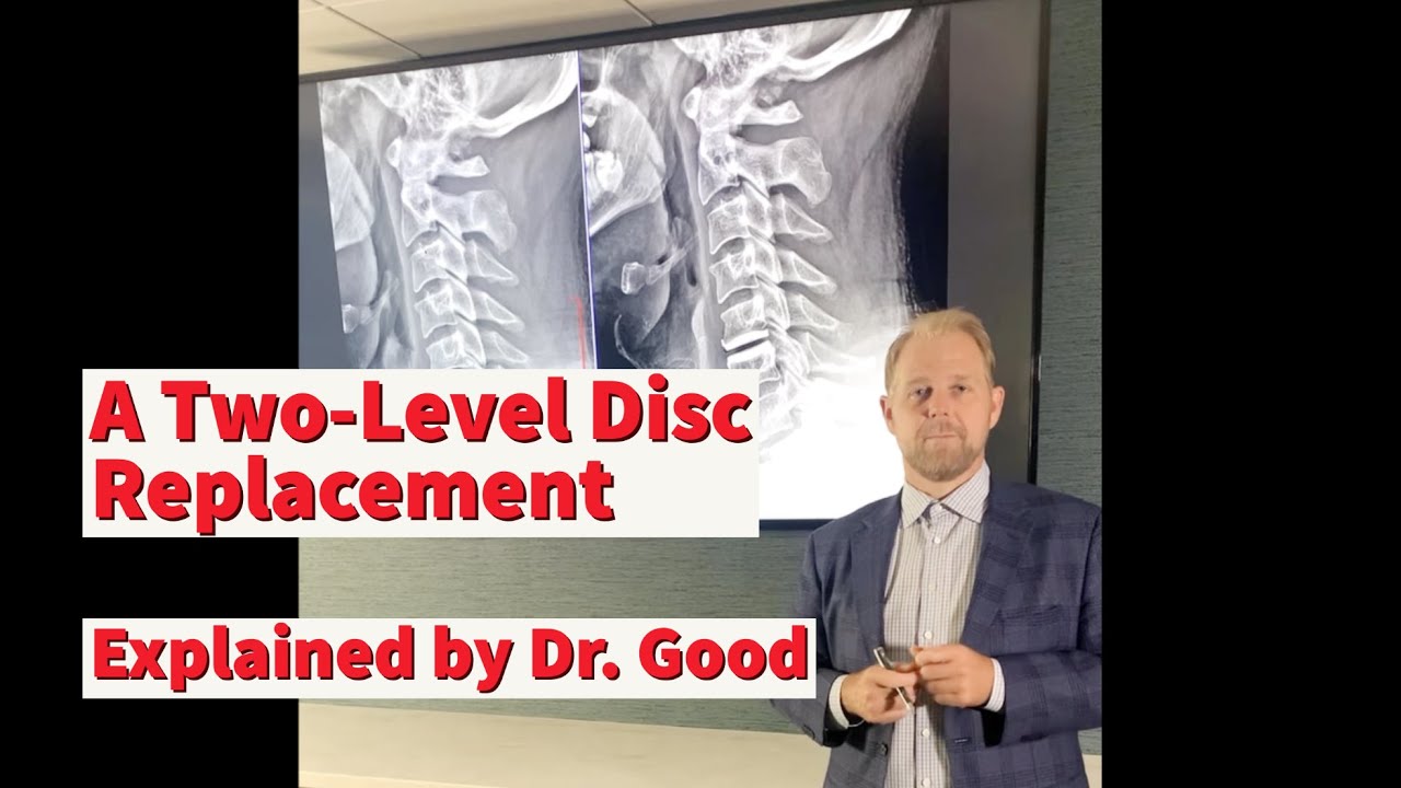A Two-Level Disc Replacement, Explained by Dr. Good - YouTube
