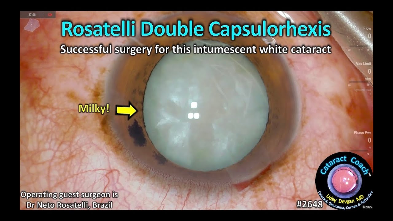 CataractCoach™ 2648: Rosatelli double capsulorhexis for white cataracts ...