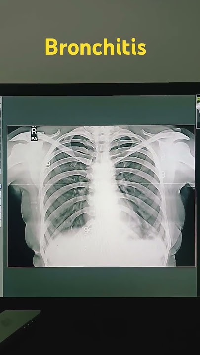 xary Chest pa Bronchitis BVM-are prominent Lung fild short video please ...