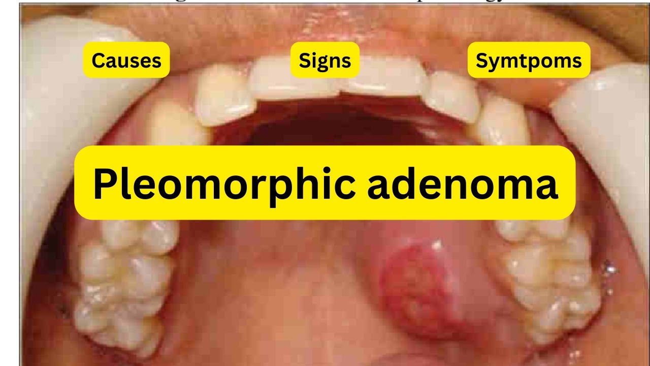 What is pleomorphic adenoma? - YouTube