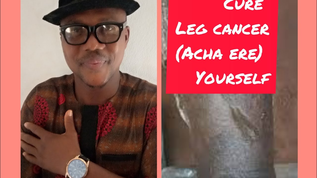 DO YOU KNOW YOU CAN CURE LEG CANCER ( ACHA ERE) WITHOUT SPENDING MONEY ...