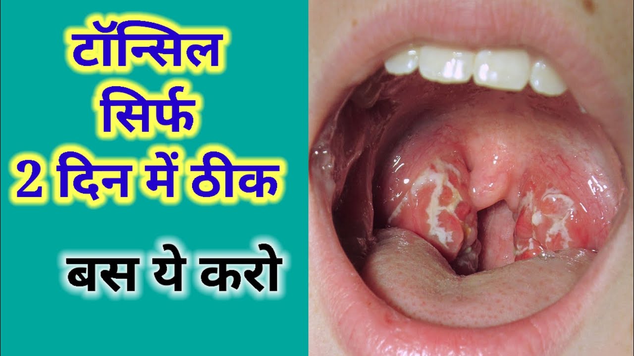 टॉन्सिल सिर्फ 2 दिन में ठीक,Tonsil ko kaise thik karen,Tonsil treatment ...