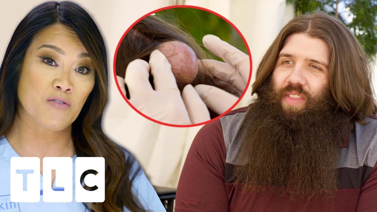 Dr. Lee Removes A QUADRUPLE Cyst On A Man's Head | Dr. Pimple Popper ...